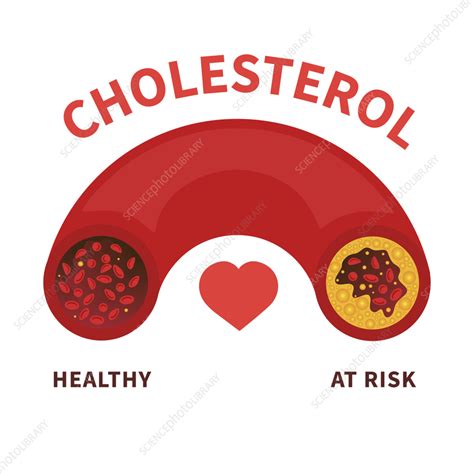 Cholesterol Levels Conceptual Illustration Stock Image F0413131