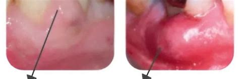 Gingival Abscess Vs Periodontal Abscess Whats The Difference