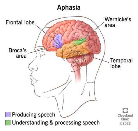 Aphasia Types Symptoms And Causes