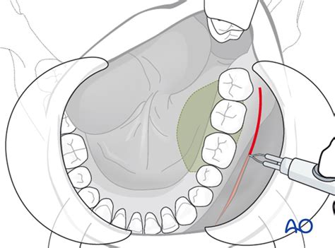Visor Approach Approach To The Mandible