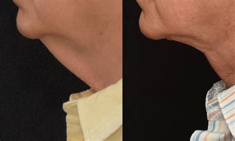 Lower Face And Neck Lift Brian P Dickinson Md