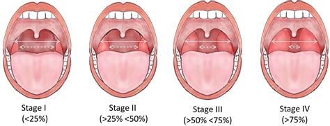 Amígdalas Amigdalitis Y Cirugía Láser De Amígdalas