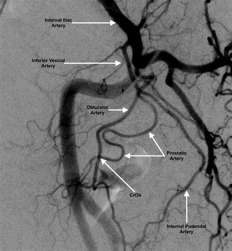Crossing Obturator Sign Angiographic Feature To Aid Prostatic Artery Identification Journal