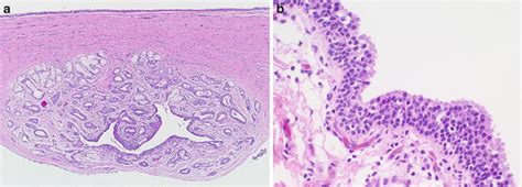 Gartners Duct Cyst Histology