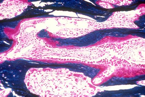 Osteomalacia Biopsy Specimens Lm Stock Image C0502588 Science