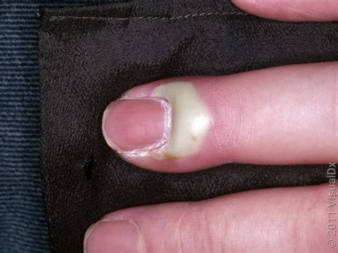 What Does A Nail Bed Infection Look Like Find Out With Pictures Goodrx