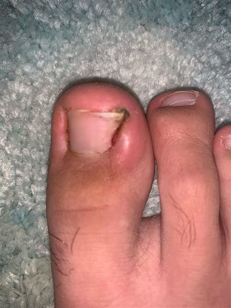 Took A Bit Too Much Of My Toenail Is It On The Way To Being Ingrown