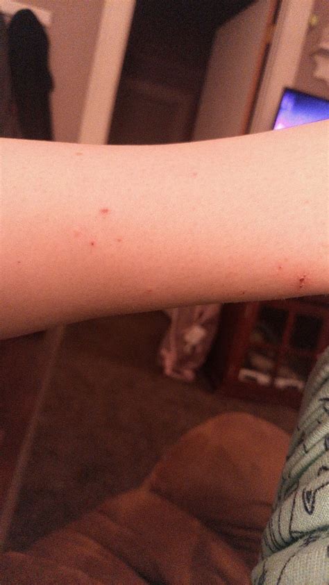 Chiggers Or Something Else R Gardening