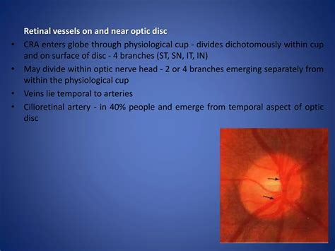 Optic Disc Evaluation Pptx