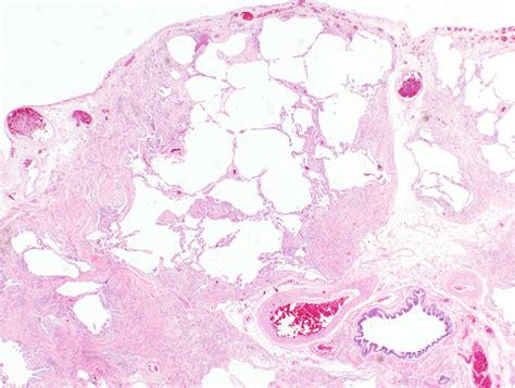 Usual Interstitial Pneumonia — 6 Patterns Of Pulmonary Pathology