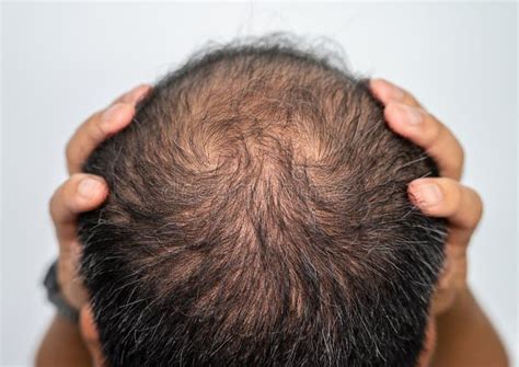 A Bald Spot On Men S Head Baldness Is Related To Your Genes And Male