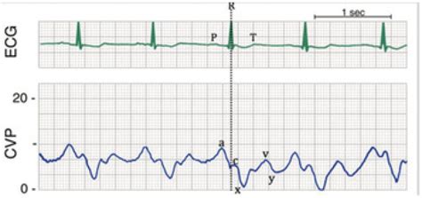 Chapter 30 Cardiovascular Monitoring Anesthesia Key