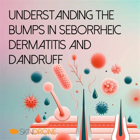 Understanding The Bumps In Seborrheic Dermatitis And Dandruff Skindrone