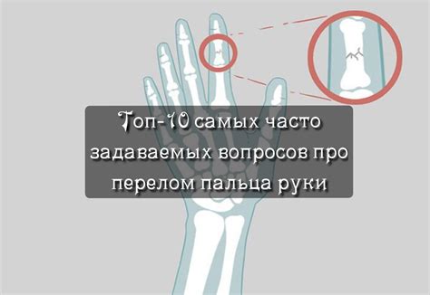Топ 10 самых часто задаваемых вопросов про перелом пальца руки ...