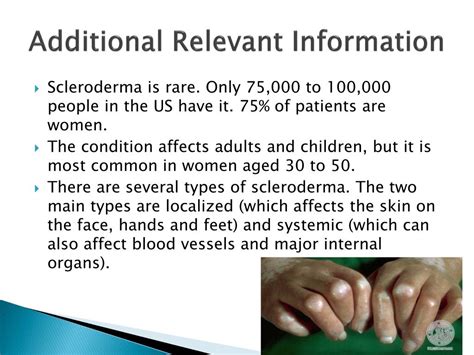 Ppt Scleroderma Powerpoint Presentation Free Download Id2583575