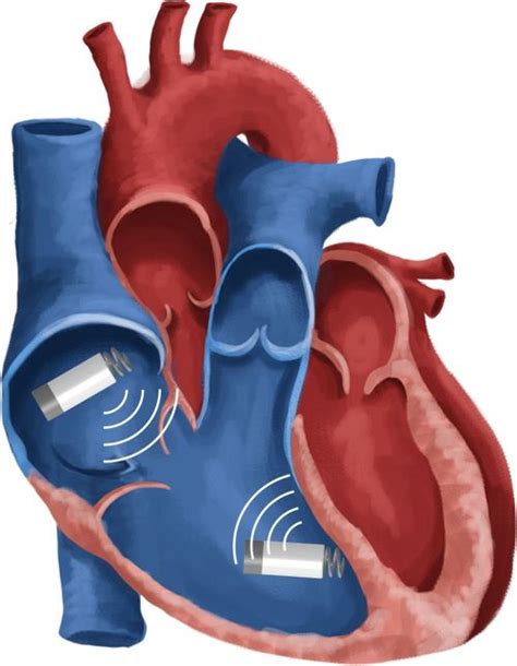 Ddd Vs Dddr Pacemaker Dr S Venkatesan Md