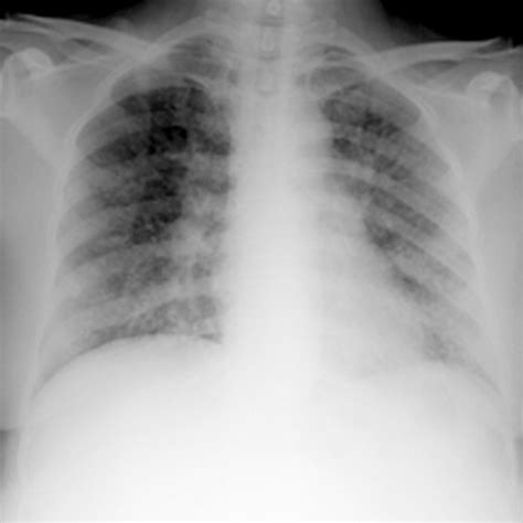 Chest Radiograph Showing Diffuse Nodular And Patchy Pulmonary