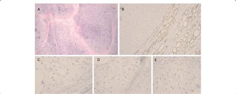 A Tumor Formed Of Lobules Of Malignant Chondrocytes Embedded In A Download Scientific Diagram