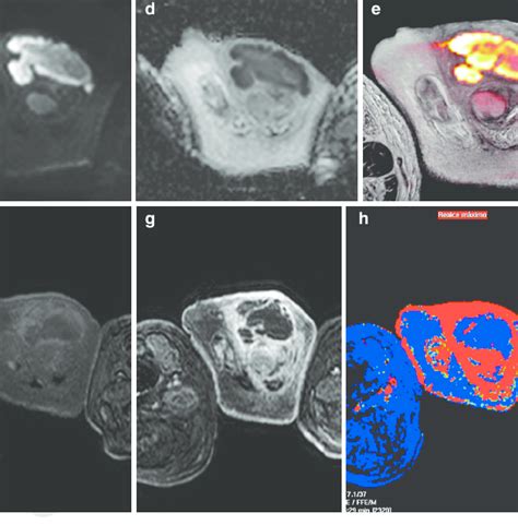 12 Pyocele In A 69 Year Old Man Us A Depicted A Large Download Scientific Diagram