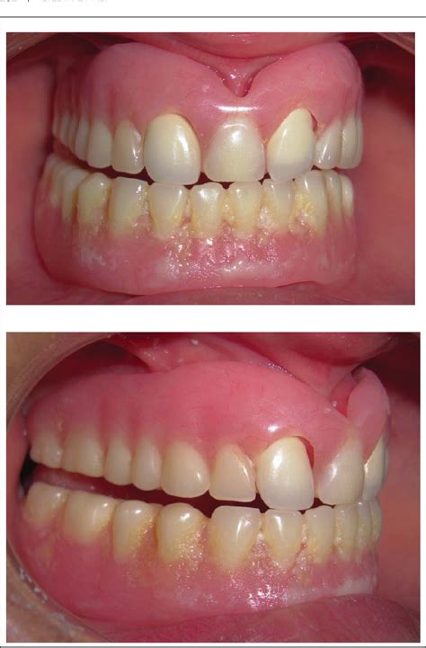 Figure 1 From Hypohidrotic Ectodermal Dysplasia A Multidisciplinary