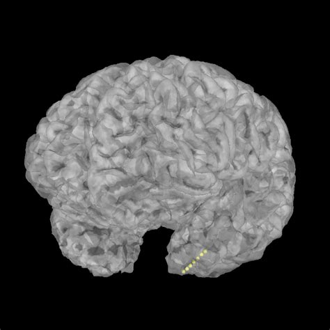 Locating Micro Scale Intracranial Electrode Contacts — Mne Gui Addons 0