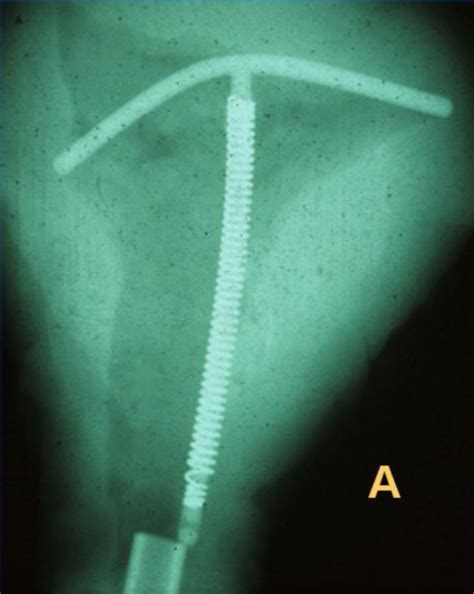 Uterus Doccheck Flexikon