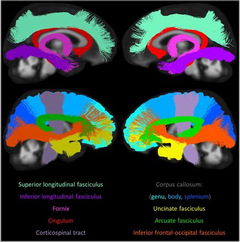 Inferior Longitudinal Fasciculus
