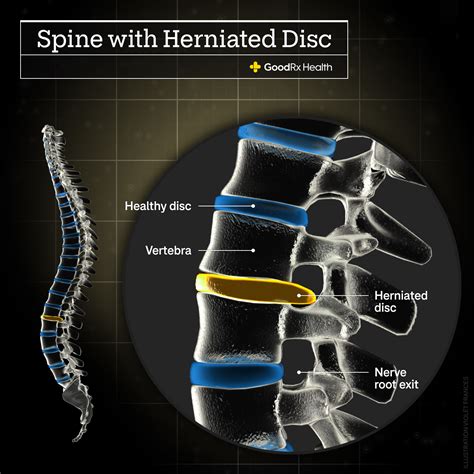 What Does ‘throwing Your Back Out Actually Mean Goodrx
