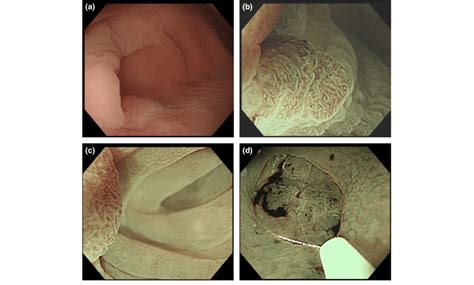 A Colonoscopy Shows A Flat Elevated Lesion Adjacent To The