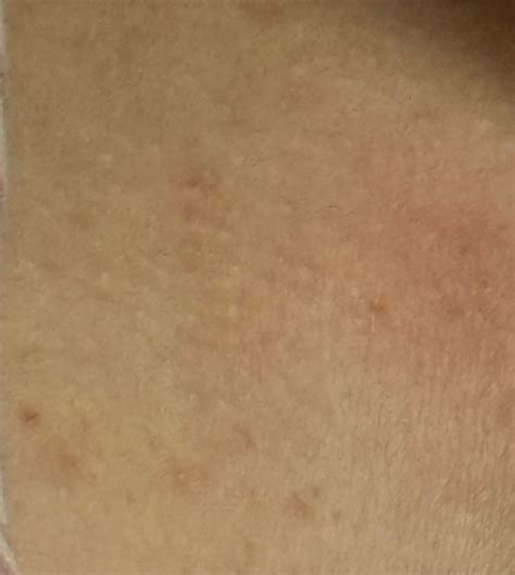 가슴쪽 피부타입가드름 등드름 없애는 방법 알려주세요 지식in