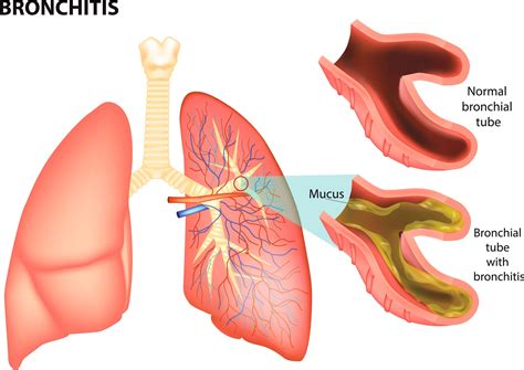 Bronchitis Ambient Virtual Care