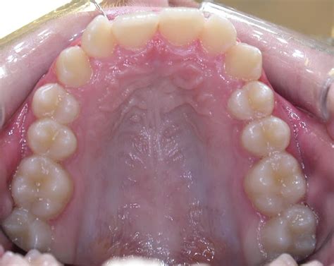 Treatment Of Angle Class Ii Division Ii Malocclusion With Deep Overbite