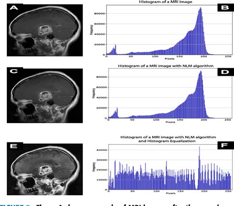 Figure 1 From A New Convolutional Neural Network Architecture For Automatic Detection Of Brain