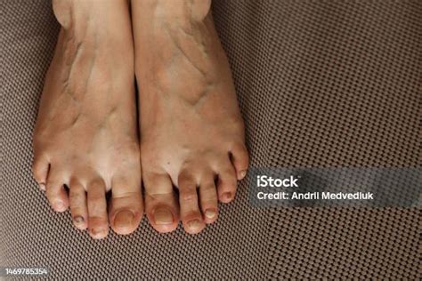 혈종 외상 곰팡이 감염 또는 화학 요법으로 인한 검은 발톱이있는 사람 발 발톱의 황변을 일으키는 곰팡이 감염 인 Onychomycosis로 고통받는 여성 건강관리와 의술에