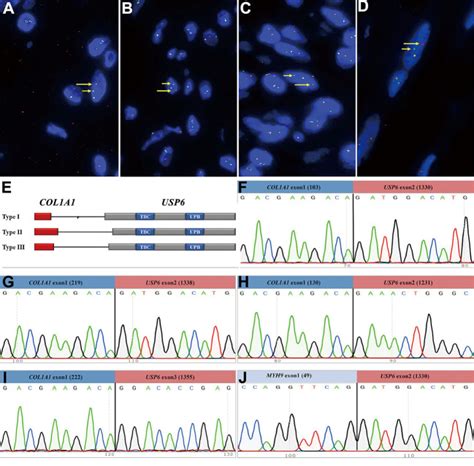Usp6 Associated Soft Tissue Tumors With Bone Metaplasia