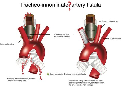 Tracheostomy Complications With Dr Sean Coulson Em Daily