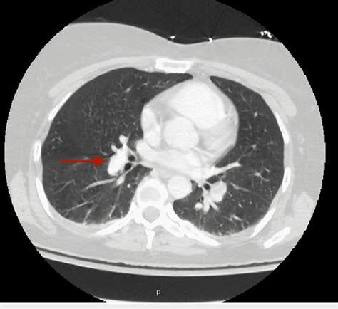 Ct Of Chest With Contrast Showing The Nodule Discovered On Plain Download Scientific Diagram
