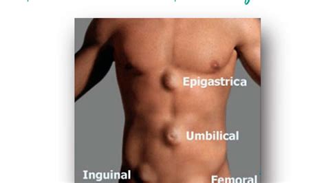 Hernia En El Estomago Sintomas Cirugía De Hernia Abdominal Tipos