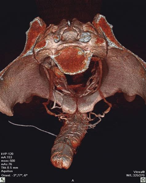 Erectile Dysfunction And Cavernous Veno Occlusive Disease