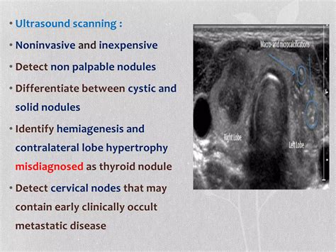 Approach To Thyroid Nodule Pptx