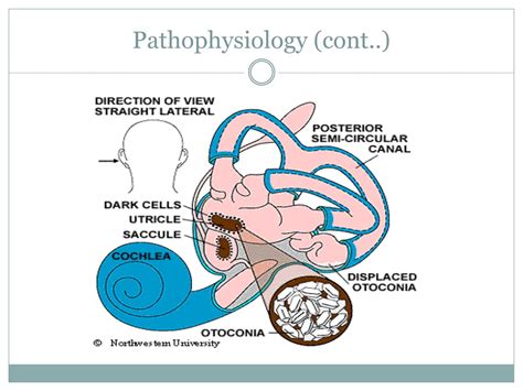 Ppt Bppv Pathophysiology Diagnosis And Facts Powerpoint