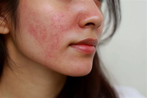 Rash Treatment Hamilton Eczema Dermatitis Psoriasis Rosacea