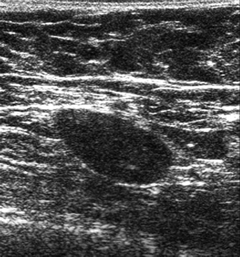 Axillary Ultrasound Identifies Residual Nodal Disease After