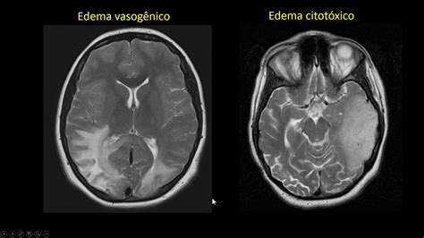 Cerebral Edema Vs Normal Brain