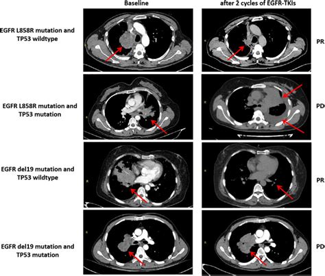 The Prognosis Of Tp53 And Egfr Co Mutation In Patients With Advanced Lung Adenocarcinoma And