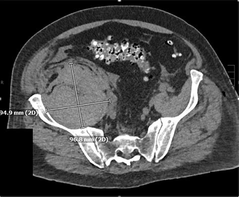 Retroperitoneal Hematoma