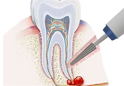 Bodrum Apical Resection Myndosdent Dental Clinic