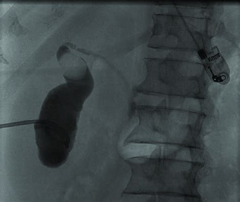 10 Days Later Follow Up Cholecystogram Revealed Calcular Filling Defect