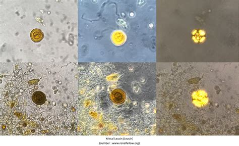 Kristal Leusin Di Urin