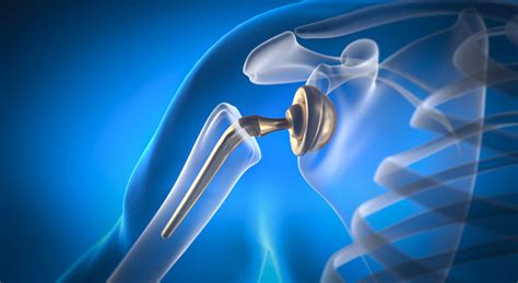 Anatomic Vs Reverse Shoulder Arthroplasty Which Shoulder Replacement